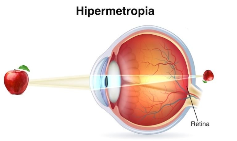 4 defectos Refractivos de la Visión